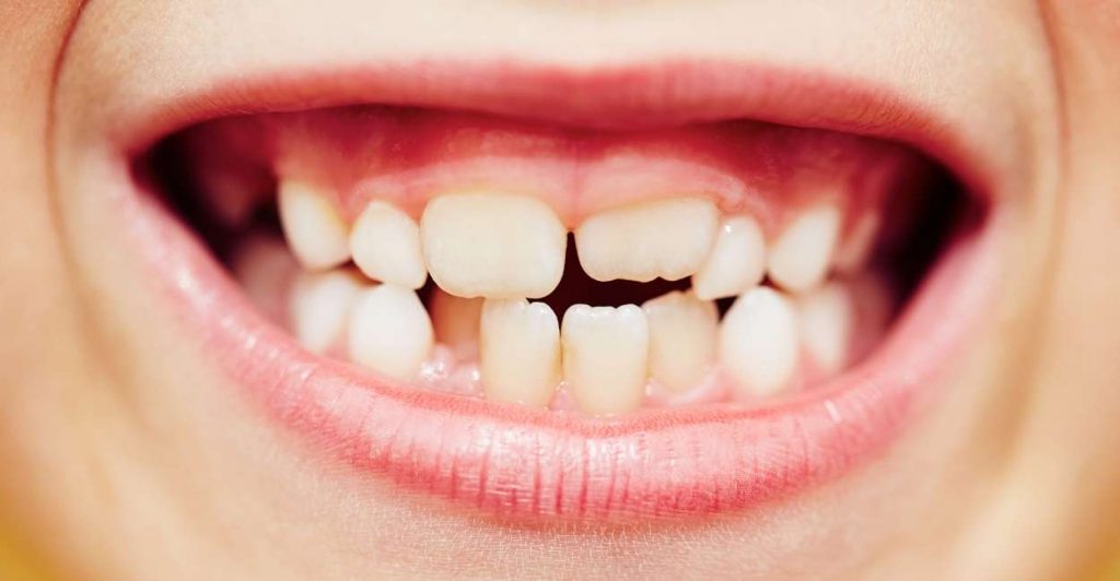 Crumbling Teeth in Dreams – Does It Imply That You Have Made an ...