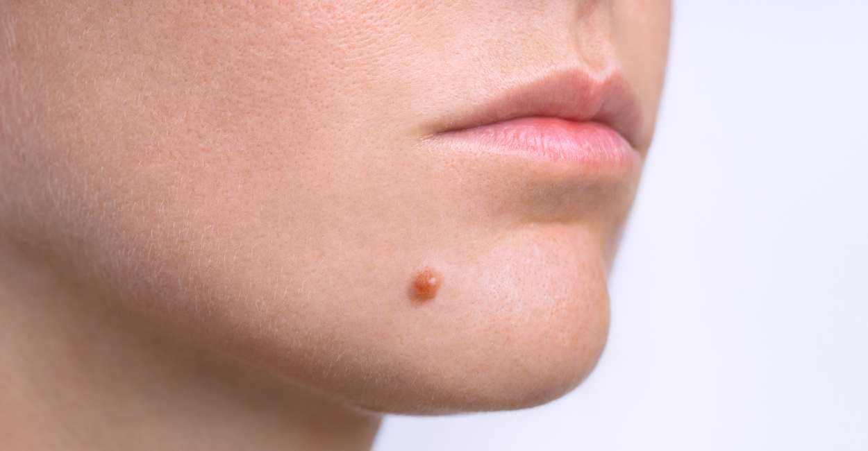 Dream of Mole on Face – You Intend to Become a Better Person